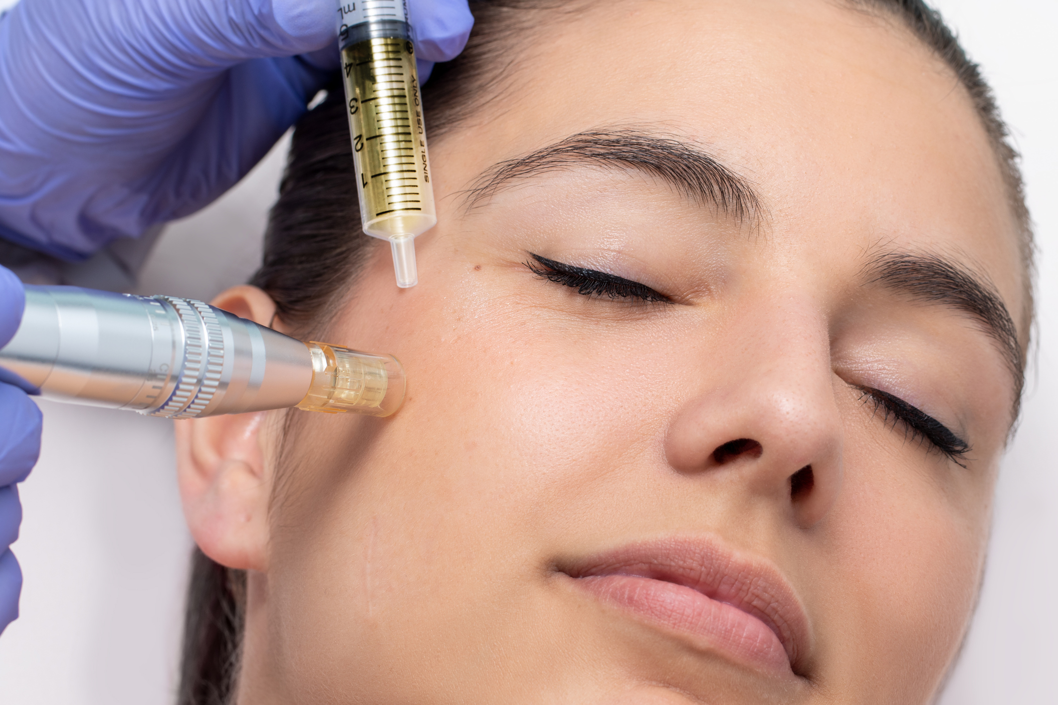 Micro Needling | Laser Lady Esthetics